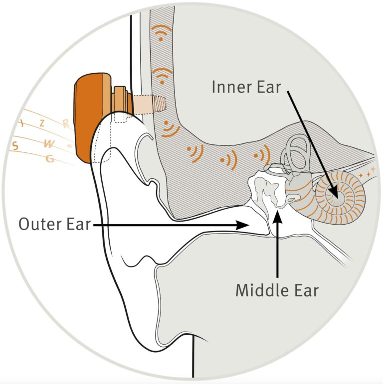 Bone Anchored Hearing | All Ears & Speech